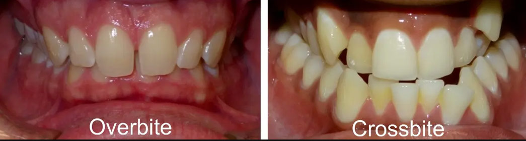 اوربایت دندان چیست: علل، علائم و درمان | دکتر احسان صانعی